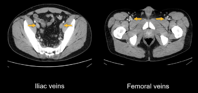 Abdominal CT: abdominal veins • LITFL • Radiology Library