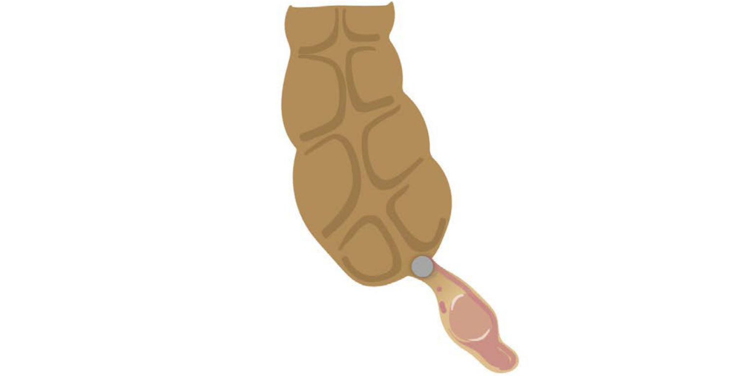 Abdominal CT: appendicitis • LITFL • Radiology Library