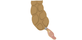 Abdominal CT: appendicitis • LITFL • Radiology Library