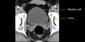 Abdominal CT: genitourinary system • LITFL • Radiology