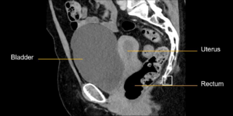 Abdominal CT: genitourinary system • LITFL • Radiology