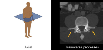 Abdominal CT: bones • LITFL • Radiology Library
