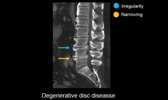 Abdominal CT: bones • LITFL • Radiology Library