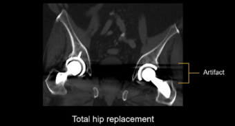Abdominal CT: bones • LITFL • Radiology Library