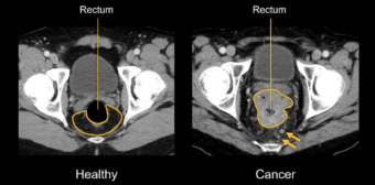 Abdominal CT: lymph nodes • LITFL • Radiology Library