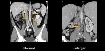 Abdominal CT: lymph nodes • LITFL • Radiology Library
