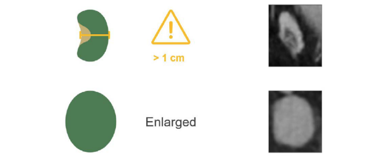 Abdominal CT: lymph nodes • LITFL • Radiology Library