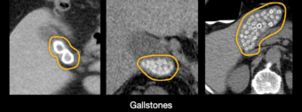 Abdominal CT: cholecystitis • LITFL • Radiology Library