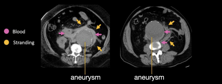 Abdominal CT: aortic aneurysm • LITFL • Radiology Library