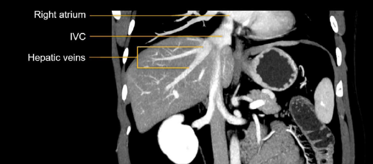 Abdominal CT: abdominal veins • LITFL • Radiology Library