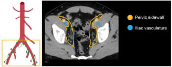 Abdominal CT: lymph nodes • LITFL • Radiology Library