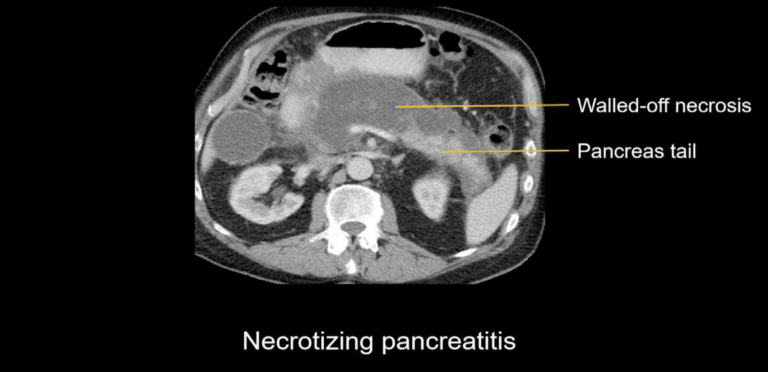 Abdominal CT: necrotizing pancreatitis • LITFL • Radiology Library