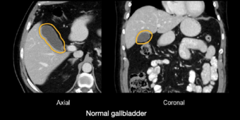 Abdominal CT: cholecystitis • LITFL • Radiology Library