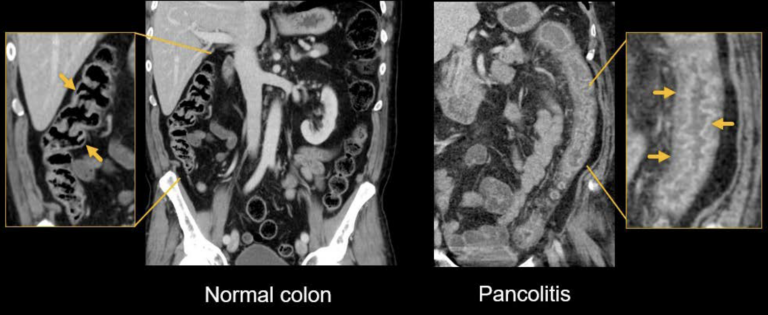 Abdominal Ct Enteritis And Colitis • Litfl • Radiology Library