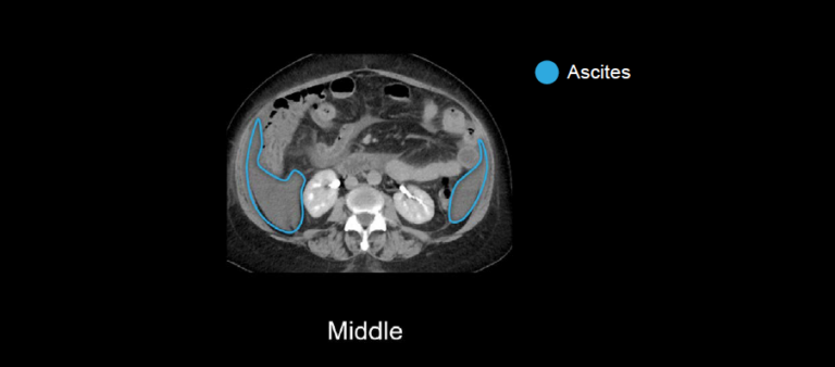 Abdominal CT: peritoneal cavity • LITFL • Radiology Library