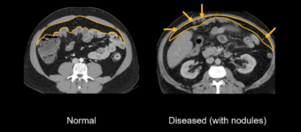 Abdominal CT: peritoneal cavity • LITFL • Radiology Library