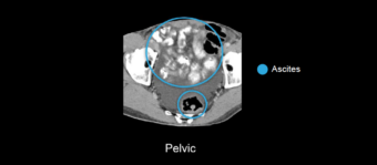 Abdominal CT: peritoneal cavity • LITFL • Radiology Library