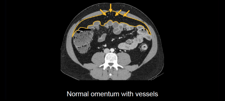 Abdominal CT: peritoneal cavity • LITFL • Radiology Library