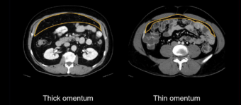 Abdominal CT: peritoneal cavity • LITFL • Radiology Library