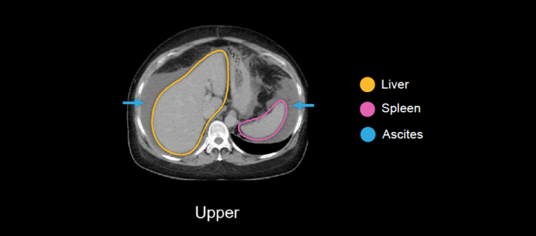 Abdominal CT: peritoneal cavity • LITFL • Radiology Library