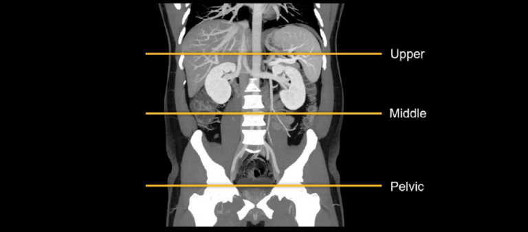 Abdominal CT: peritoneal cavity • LITFL • Radiology Library