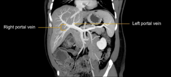 Abdominal CT: abdominal veins • LITFL • Radiology Library