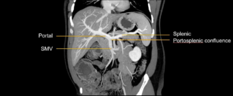 Abdominal CT: abdominal veins • LITFL • Radiology Library