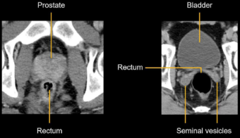 Abdominal CT: genitourinary system • LITFL • Radiology