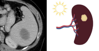 Abdominal CT: spleen and adrenal glands • LITFL • Radiology