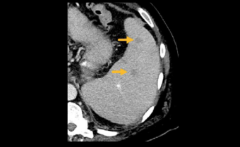 Abdominal CT: spleen and adrenal glands • LITFL • Radiology