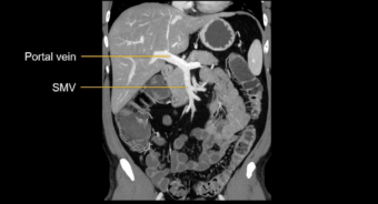 Abdominal CT: intestinal ischaemia • LITFL • Radiology Library