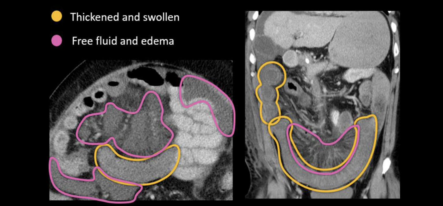 Abdominal CT: intestinal ischaemia • LITFL • Radiology Library