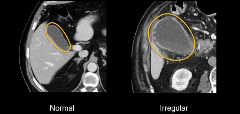 Abdominal CT: cholecystitis • LITFL • Radiology Library