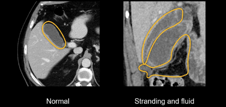 Abdominal CT: cholecystitis • LITFL • Radiology Library