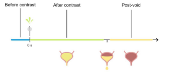 Abdominal CT: Cystogram • LITFL • Radiology library