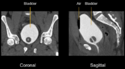 Abdominal CT: Cystogram • LITFL • Radiology library