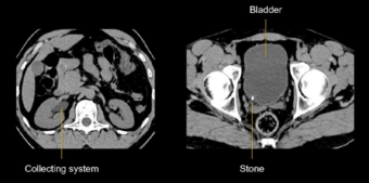 Abdominal CT: GU imaging • LITFL • Radiology library