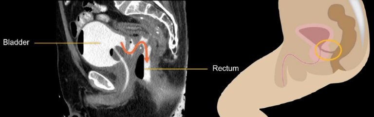 Abdominal CT: Cystogram • LITFL • Radiology library