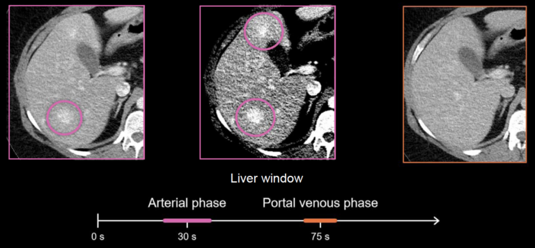 Abdominal CT: Cancer staging • LITFL • Radiology library