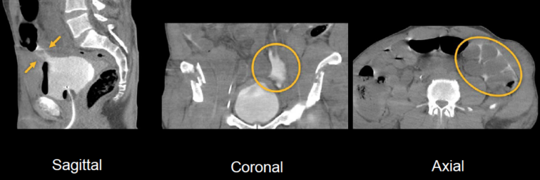 Abdominal CT: Cystogram • LITFL • Radiology library