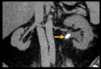 Abdominal CT: GU imaging • LITFL • Radiology library