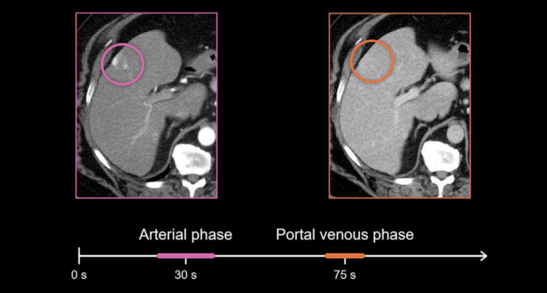 Abdominal CT: Cancer staging • LITFL • Radiology library
