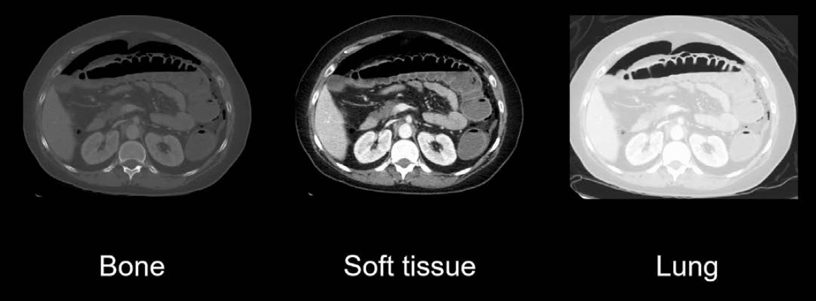 Abdominal CT: Windows advanced • LITFL • Radiology library