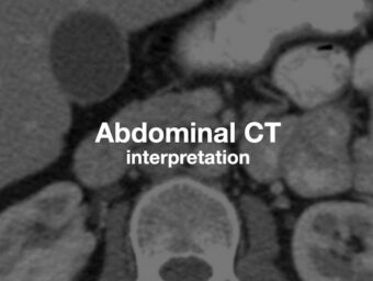 Large bowel obstruction Archives • LITFL