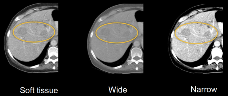 Abdominal CT: Windows advanced • LITFL • Radiology library