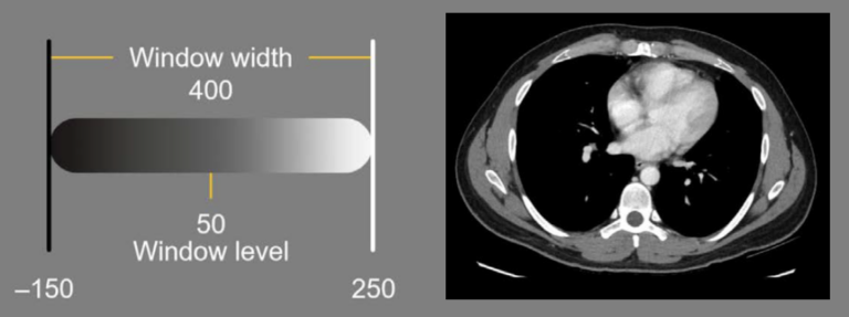 Abdominal CT: Windows advanced • LITFL • Radiology library