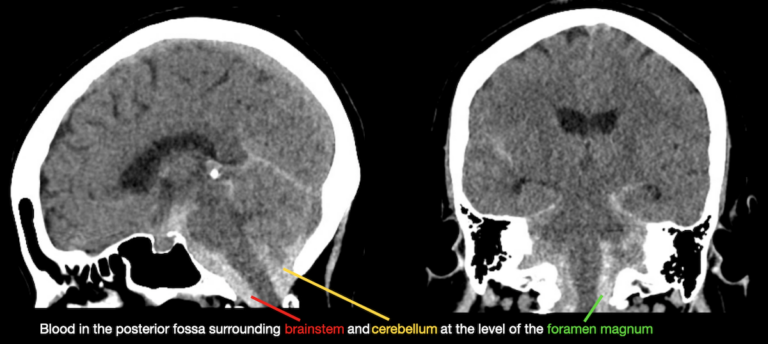 CT Case 004 • LITFL • CT scan interpretation