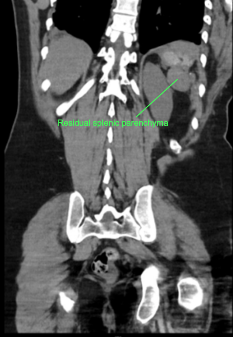 CT Case 037 • LITFL • CT scan interpretation