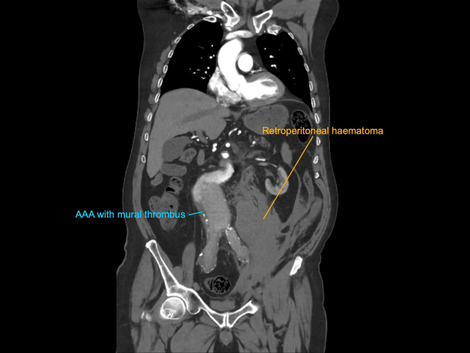 CT Case 042 • LITFL • CT scan interpretation