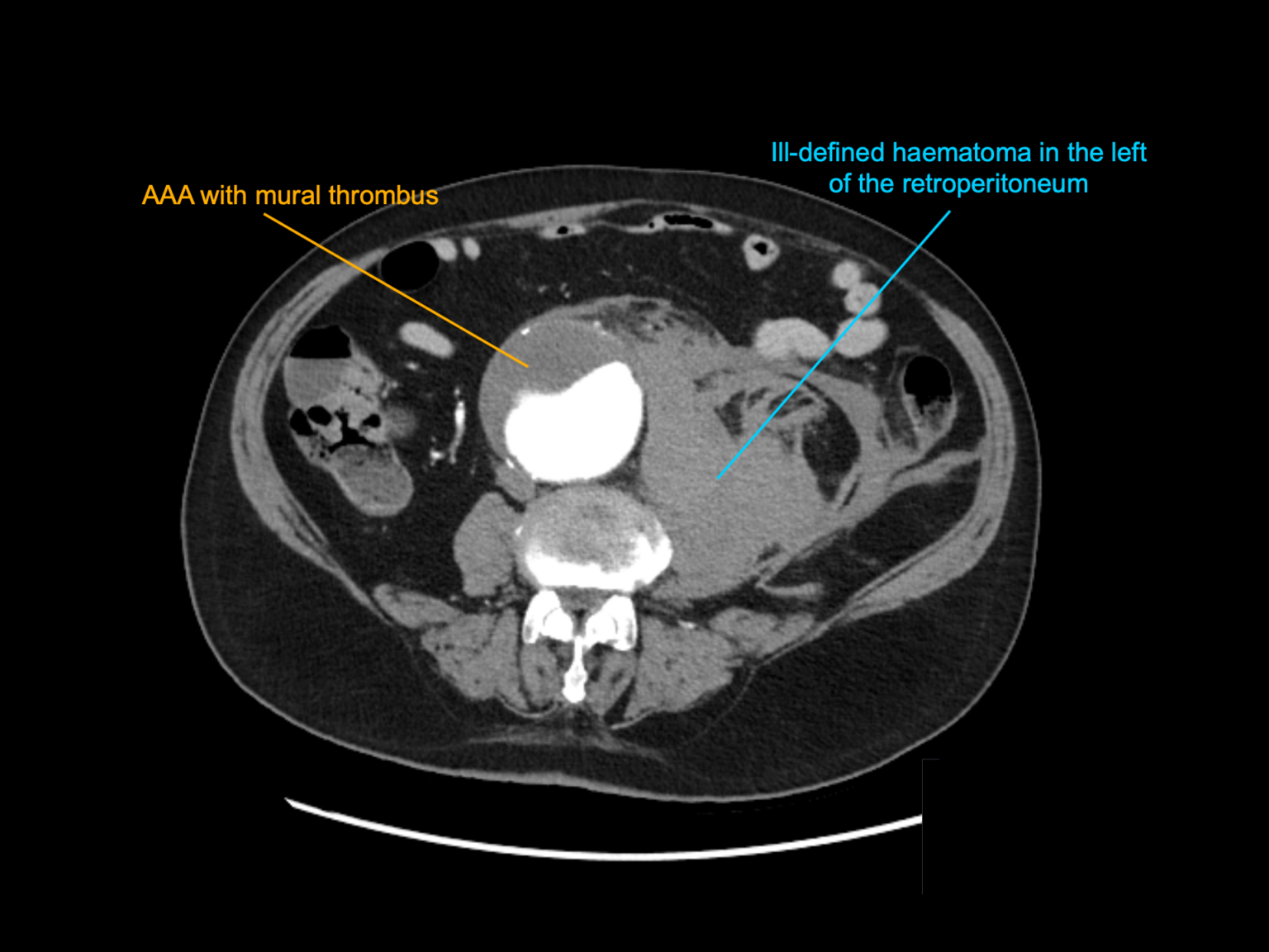 CT Case 042 • LITFL • CT scan interpretation
